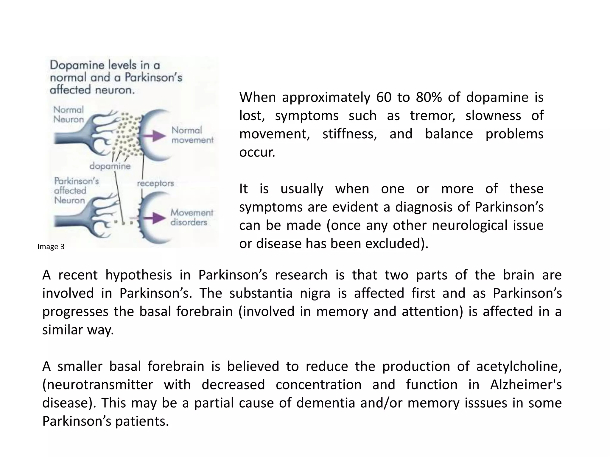 Understanding the Brain: Final Project - Parkinson’s Disease | PPSX