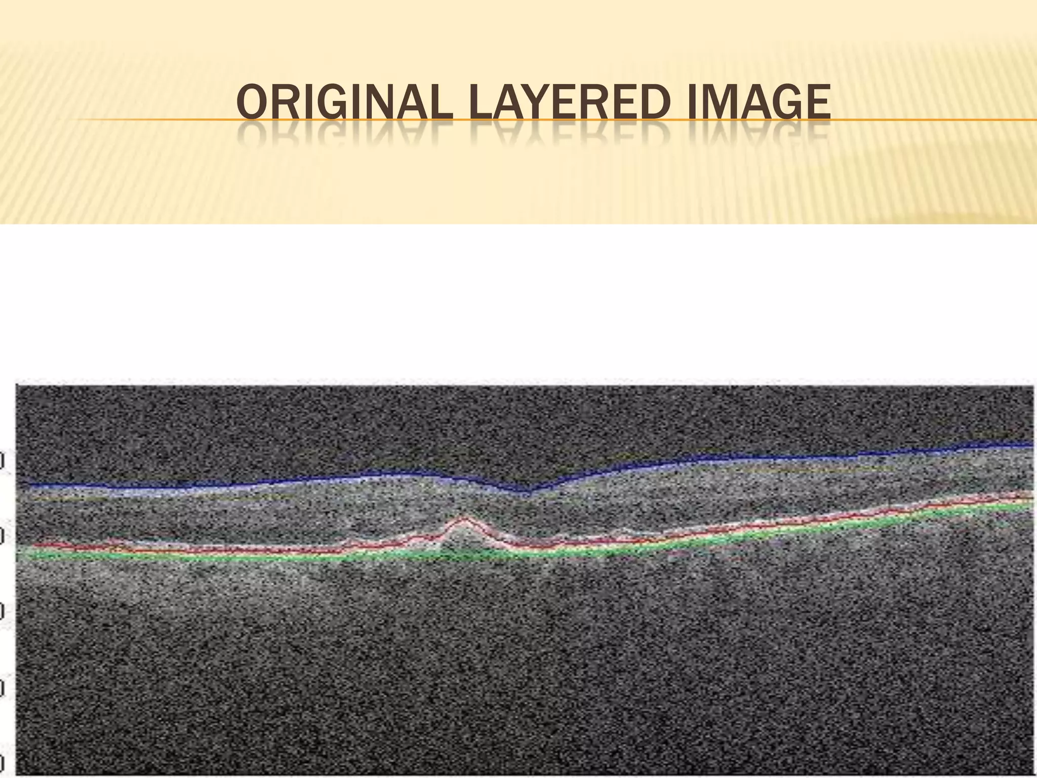 Automatic Drusen Classification | PPTX | Eye and Vision Conditions | Diseases and Conditions