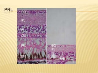 Automatic Drusen Classification | PPTX | Eye and Vision Conditions | Diseases and Conditions