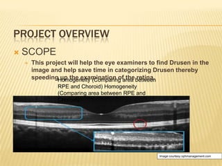 Automatic Drusen Classification | PPTX | Eye and Vision Conditions | Diseases and Conditions