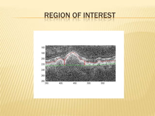 Automatic Drusen Classification | PPTX | Eye and Vision Conditions | Diseases and Conditions