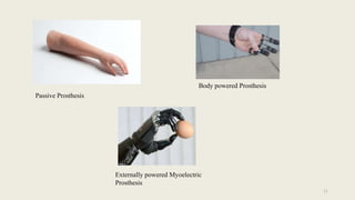 Limb Prosthetic ,types of limb Prosthetic | PPT