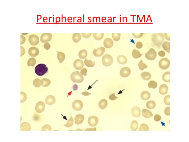 Thrombotic Microangiopathy