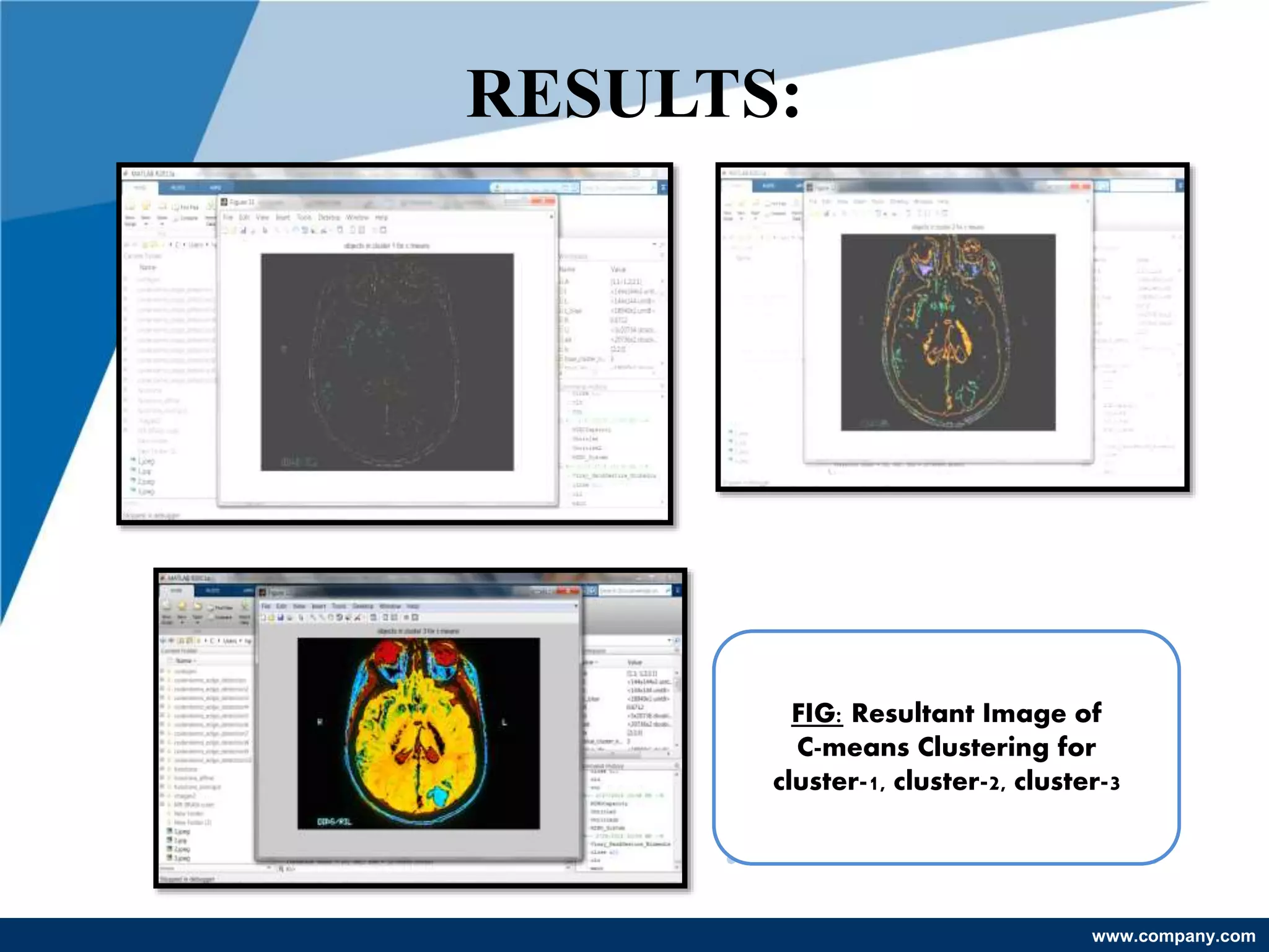 Ppt On Brain Tumor Detection In Mri Images Based On Image Segmentation