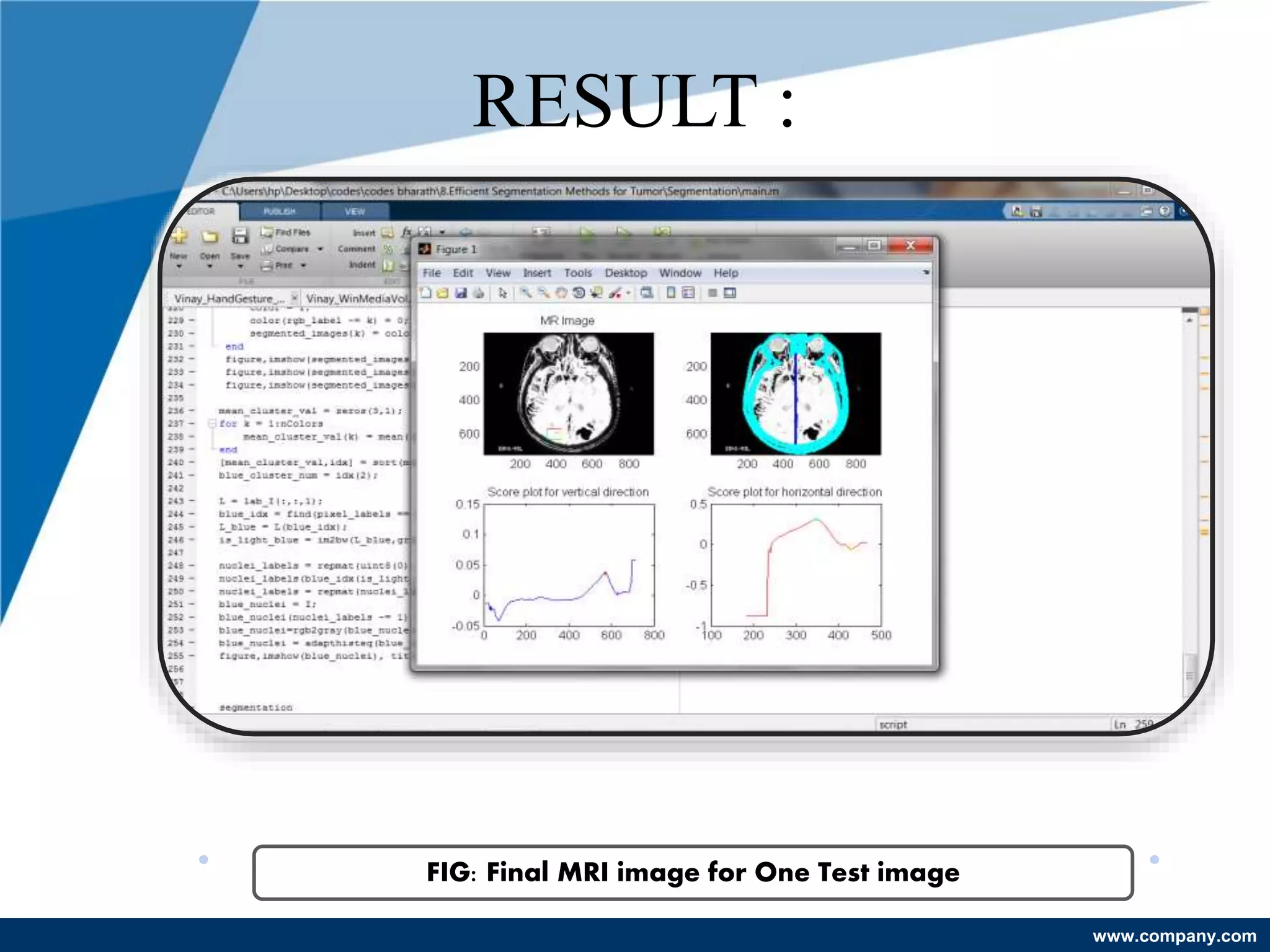 Ppt On Brain Tumor Detection In Mri Images Based On Image Segmentation