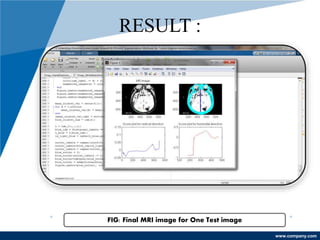 PPT on BRAIN TUMOR detection in MRI images based on IMAGE SEGMENTATION ...