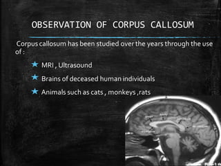CORPUS CALLOSUM (Final Review Project) | PDF