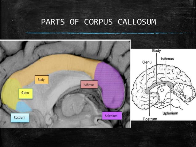 CORPUS CALLOSUM (Final Review Project) | PPT