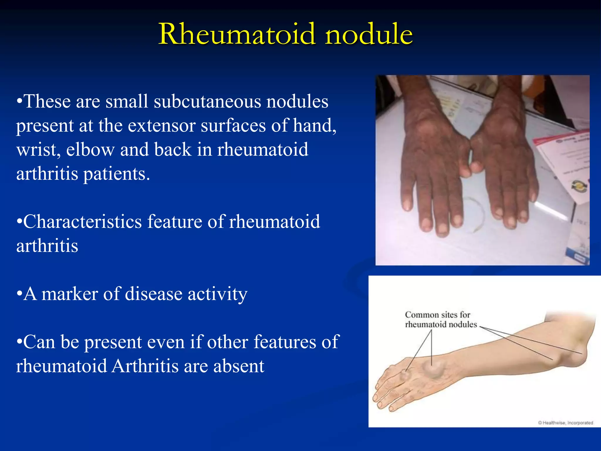 Final rheumatoid arthritis | PPT
