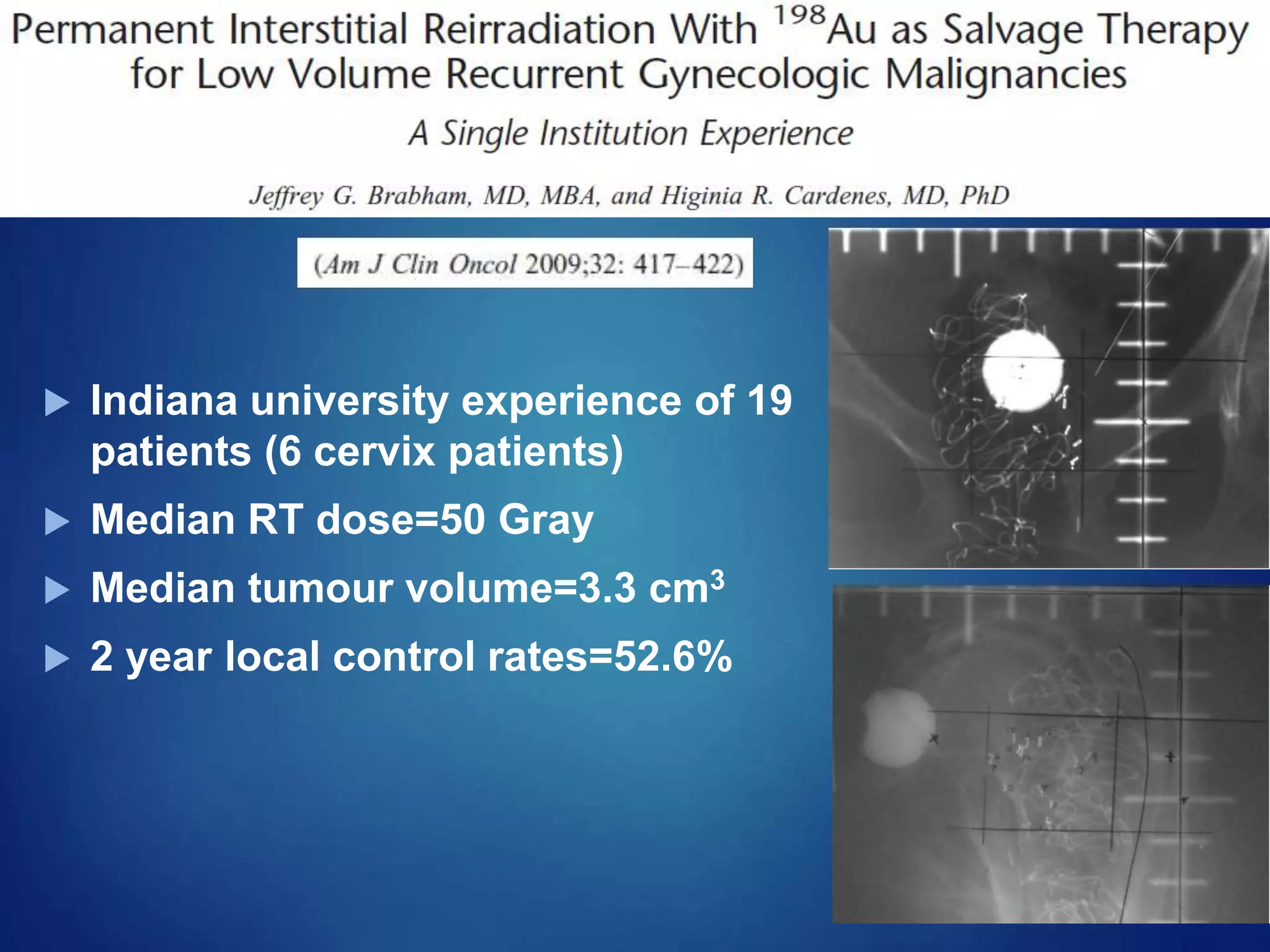 Role of radiotherapy in recurrent carcinoma cervix | PPTX
