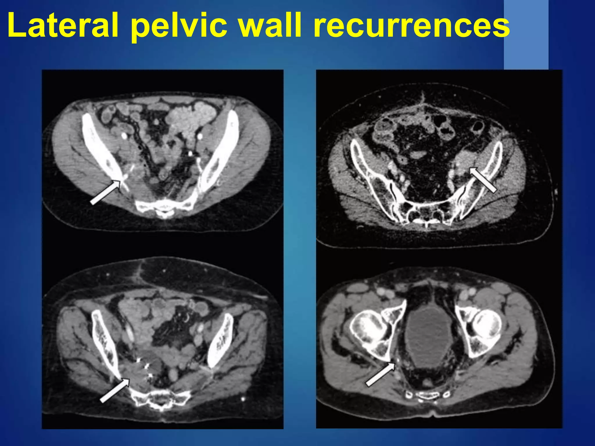 Role of radiotherapy in recurrent carcinoma cervix | PPTX