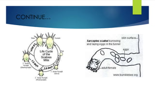 Scabies | PPTX