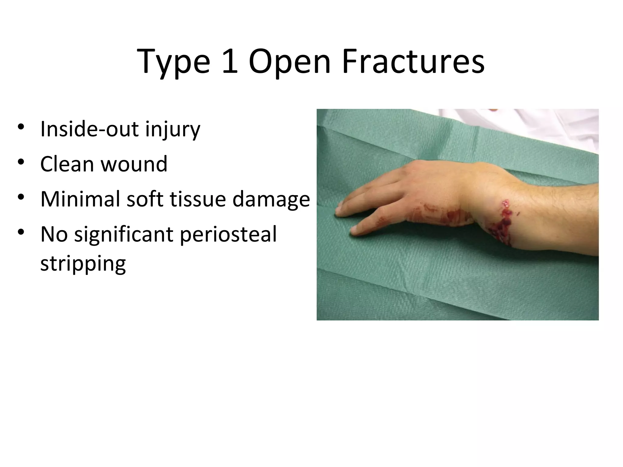 management of open fracture | PPT