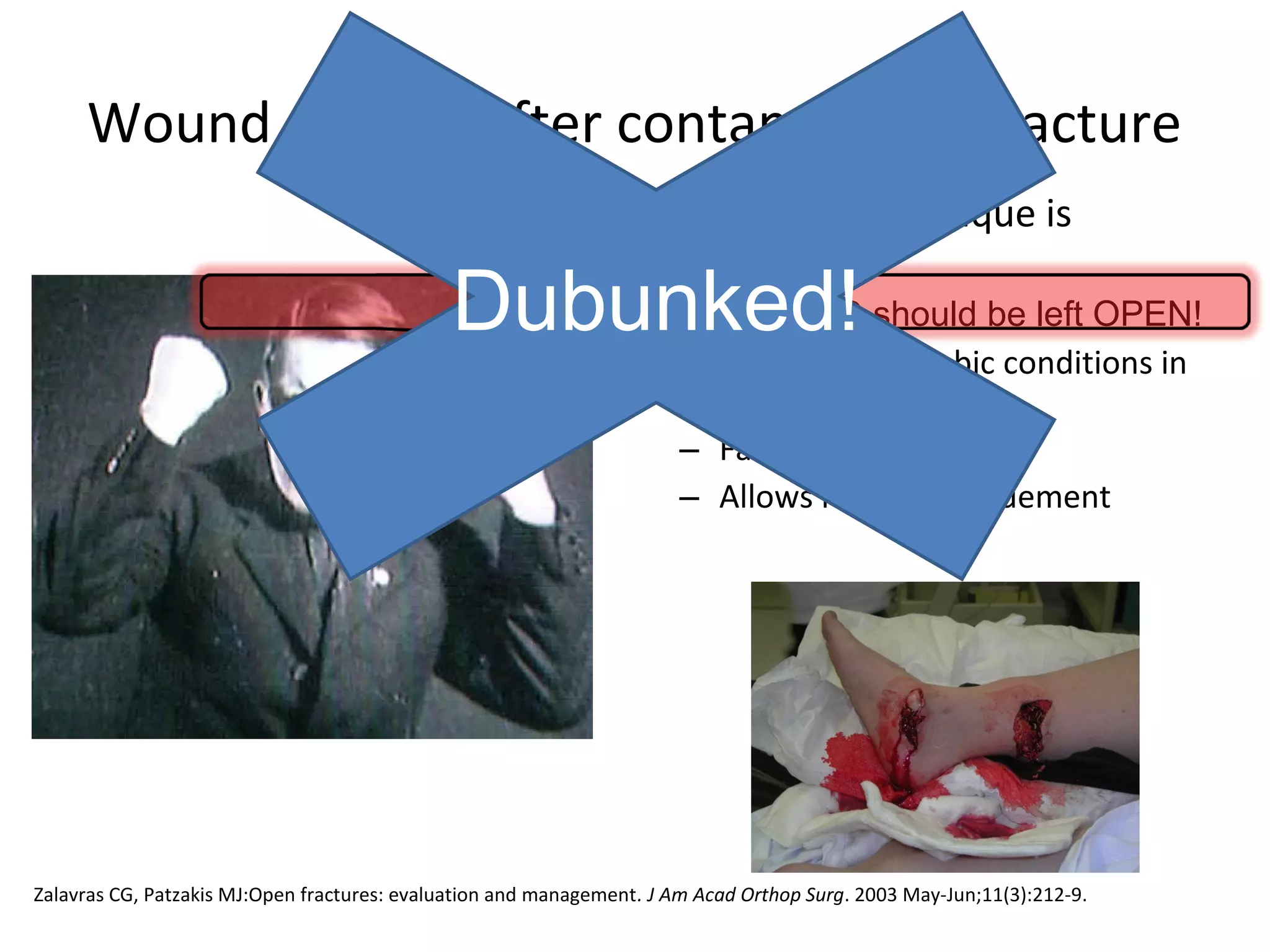 management of open fracture | PPT