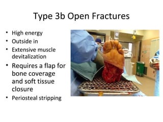 management of open fracture | PPT