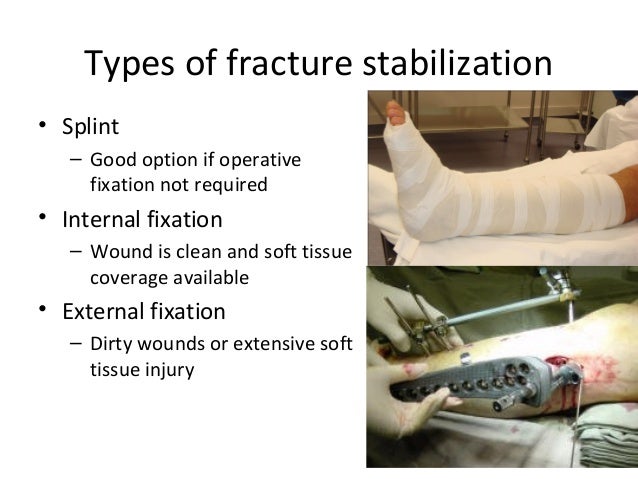 management of open fracture