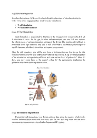 Spinal cord Stimulation | PDF