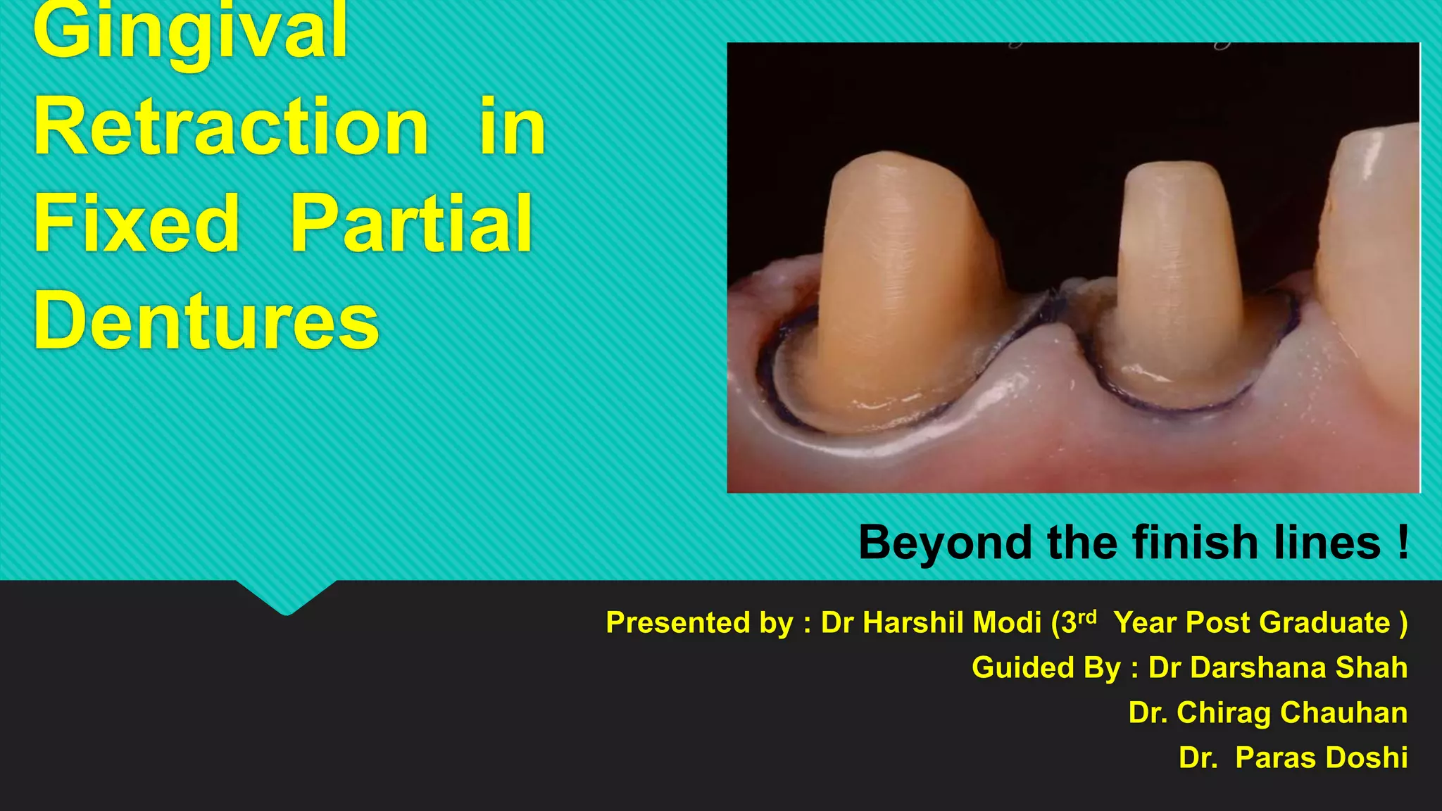 Gingival Retraction | PPTX