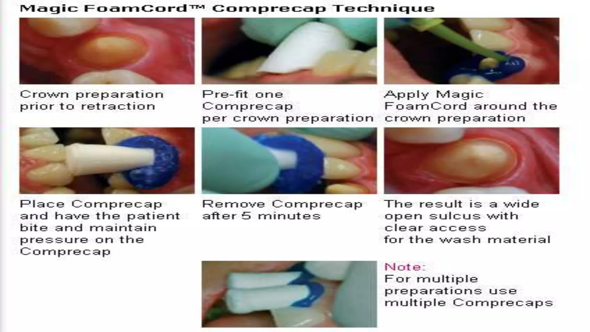 Gingival Retraction | PPTX