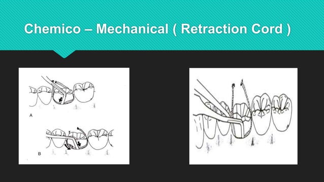 Gingival Retraction | PPT