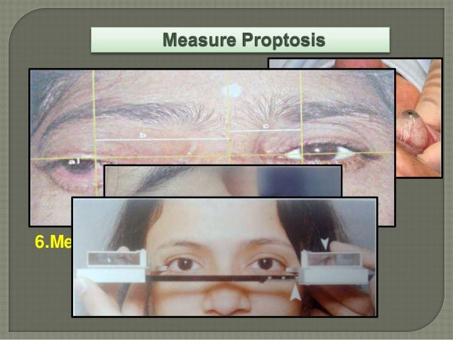 Final seminar on proptosis