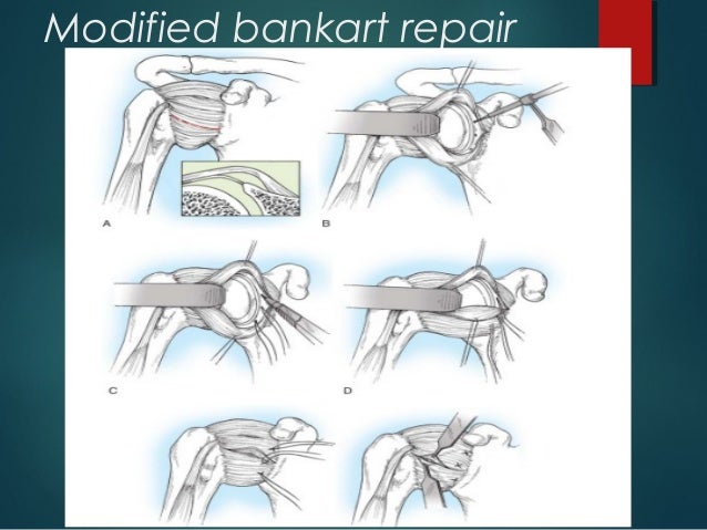 Shoulder instability