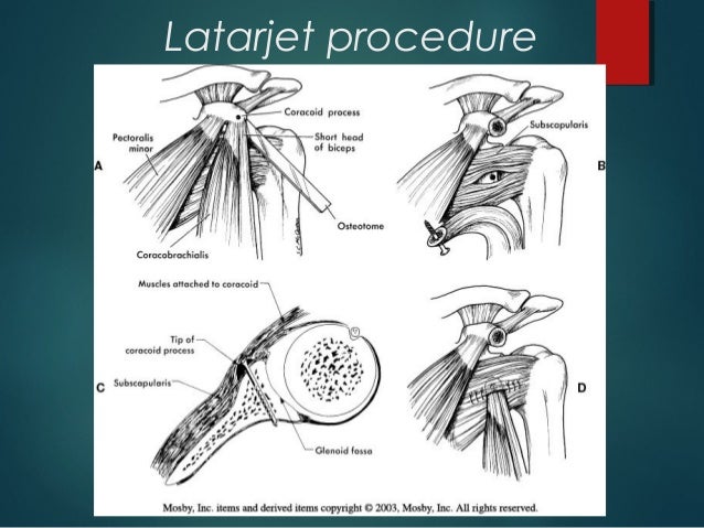 Shoulder instability