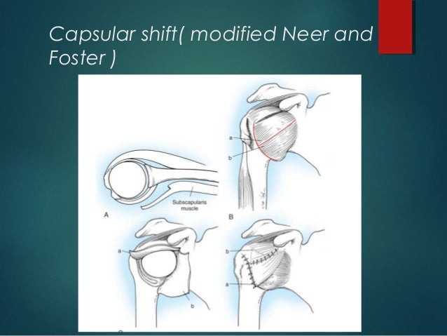 Shoulder instability