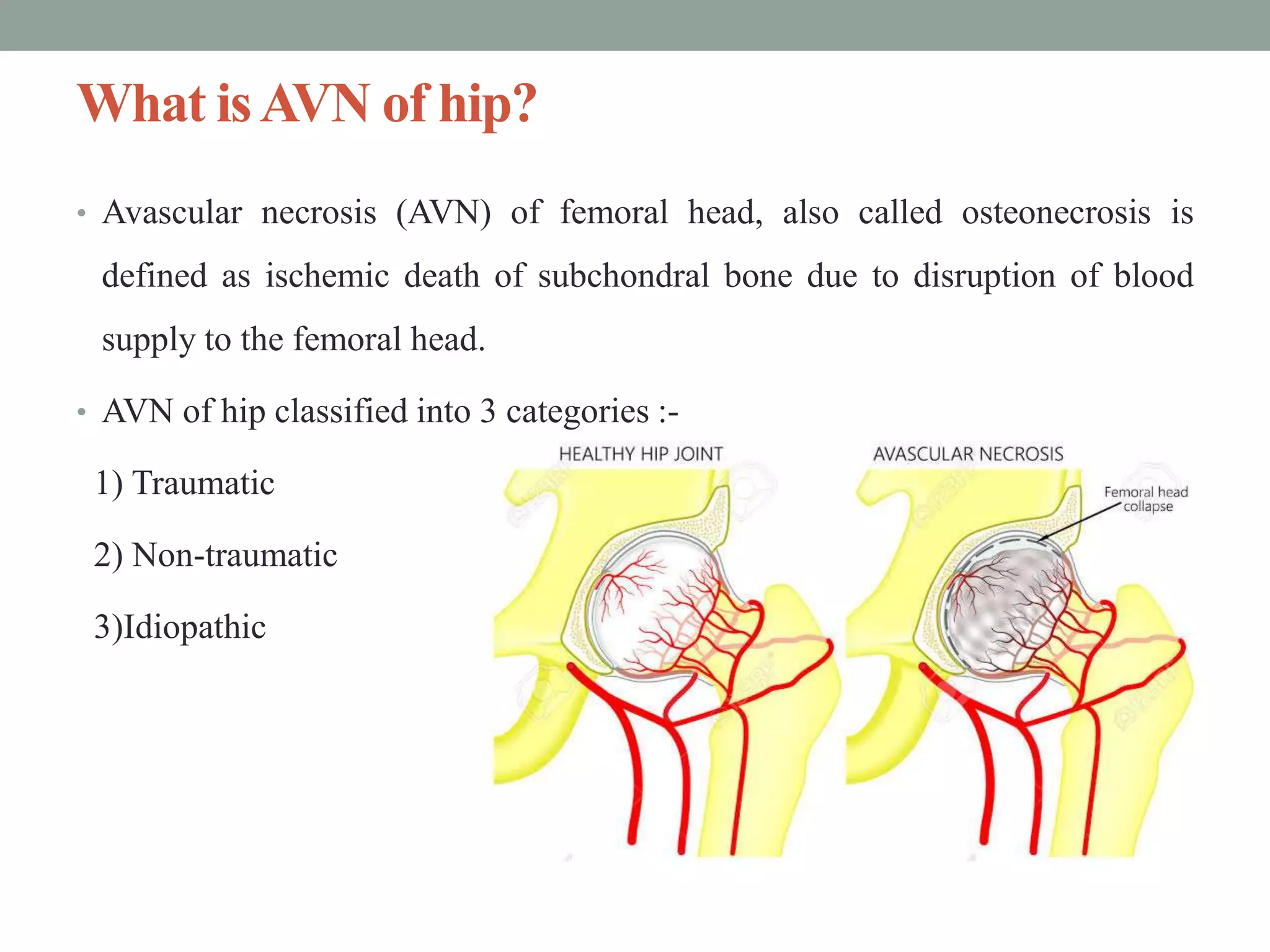 AVN Of Hip.pptx