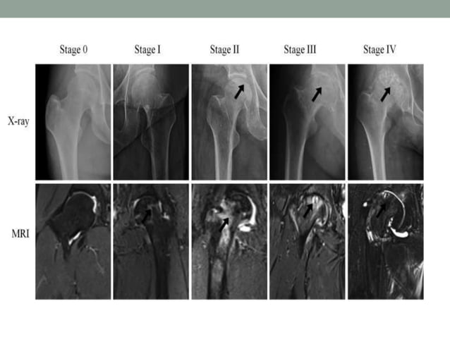 AVN Of Hip.pptx | Bone and Joint Conditions | Diseases and Conditions