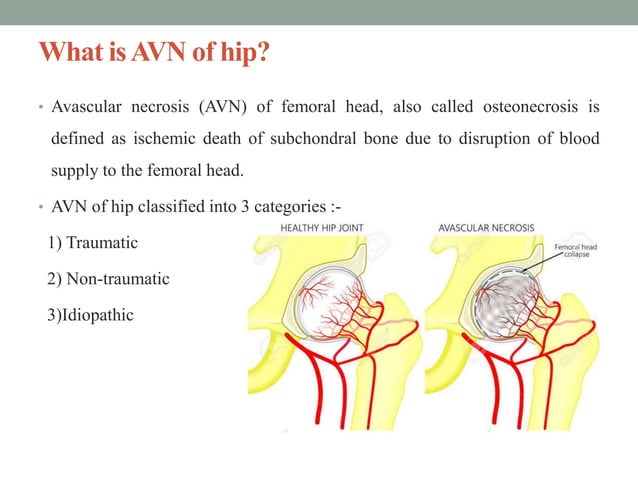 AVN Of Hip.pptx | Bone and Joint Conditions | Diseases and Conditions