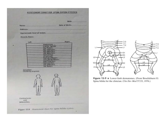Spina bifida/ dysraphism - assessment and physiotherapy management | PPTX