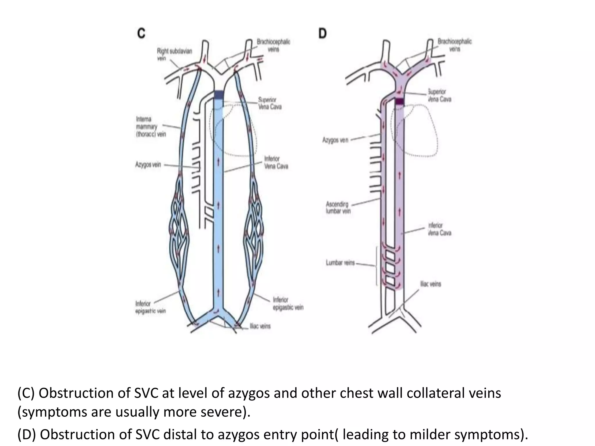 Final superior vena cava syndrome .pptx