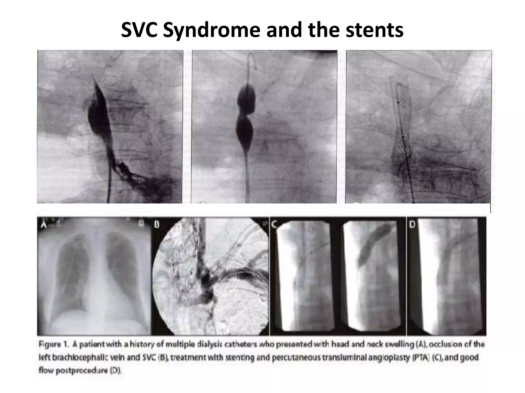 Final superior vena cava syndrome .pptx