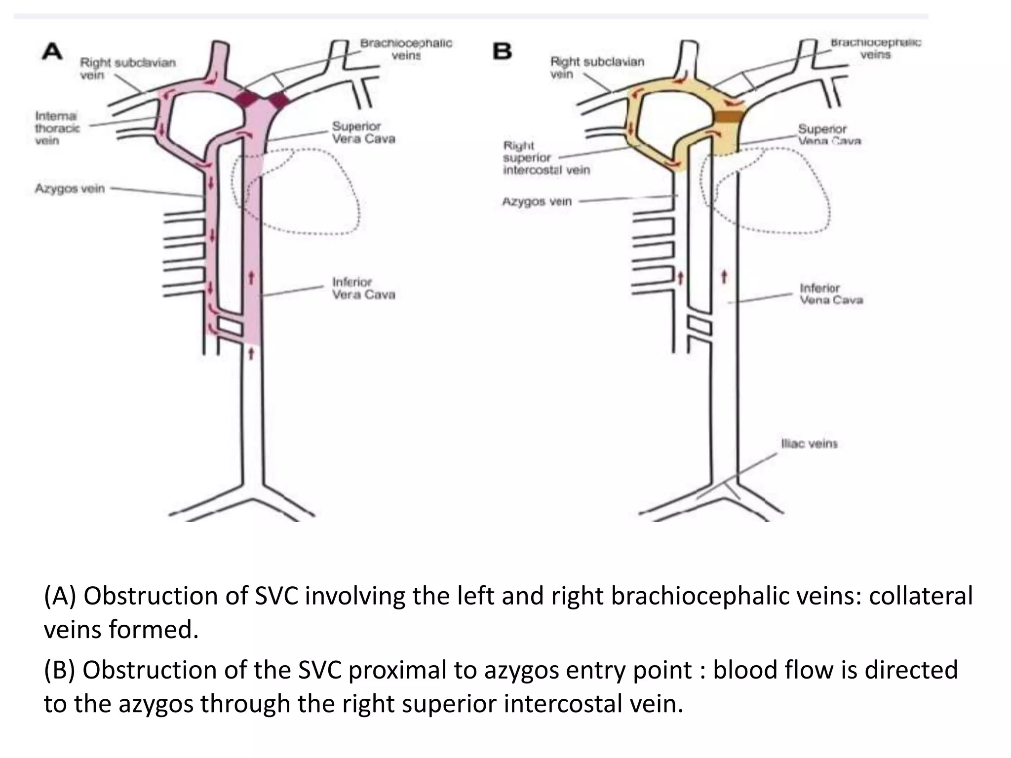 Final superior vena cava syndrome .pptx