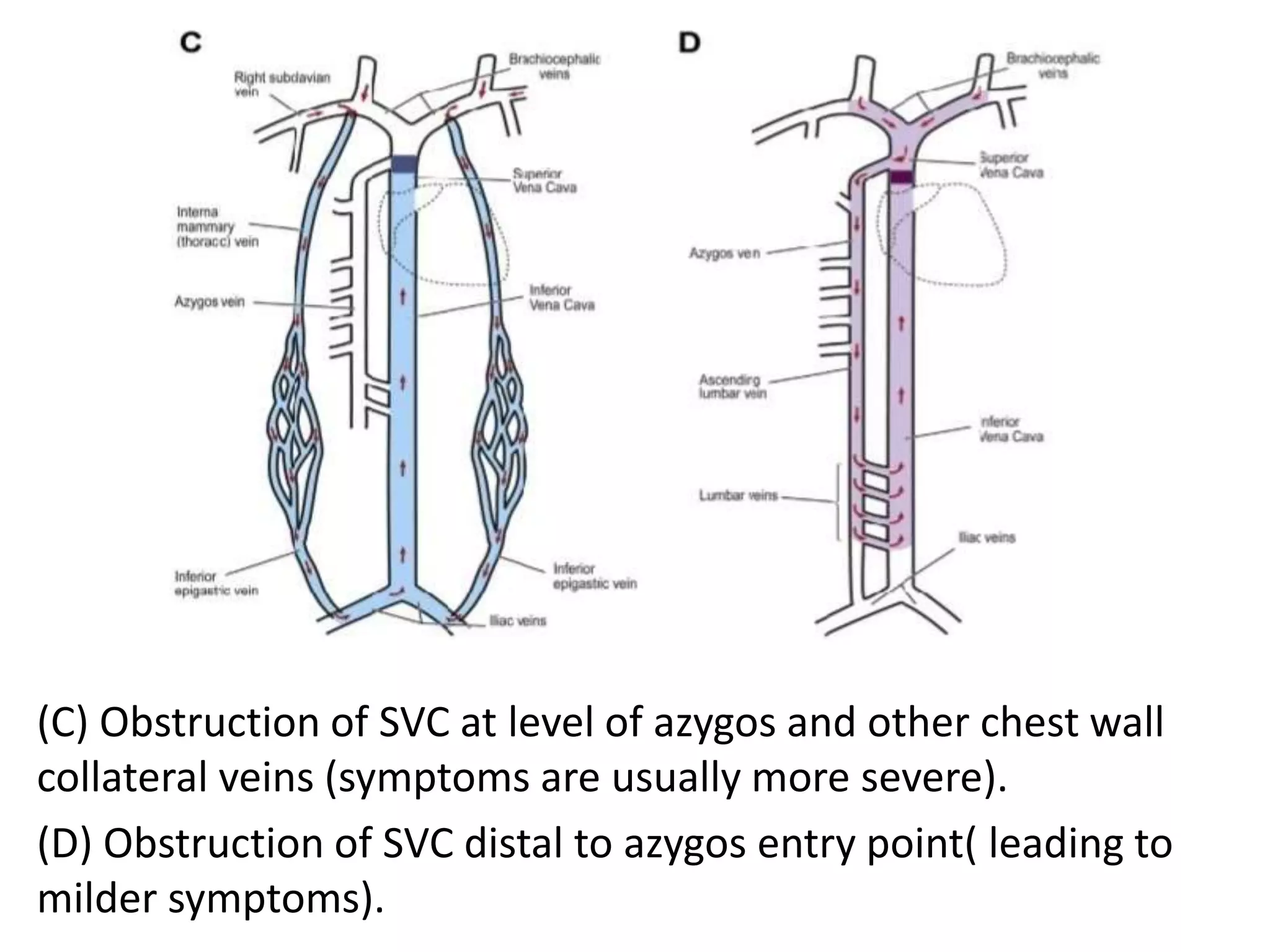 Final superior vena cava syndrome .pptx