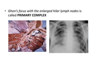 Introduction to Pediatric Tuberculosis | PPTX
