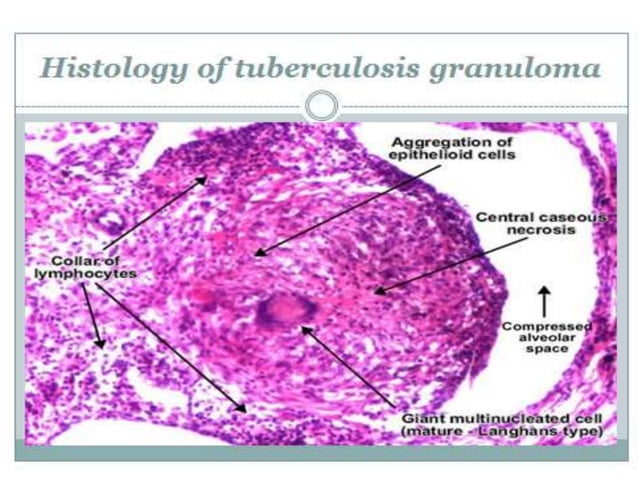 Introduction to Pediatric Tuberculosis | PPTX | Infectious Diseases ...