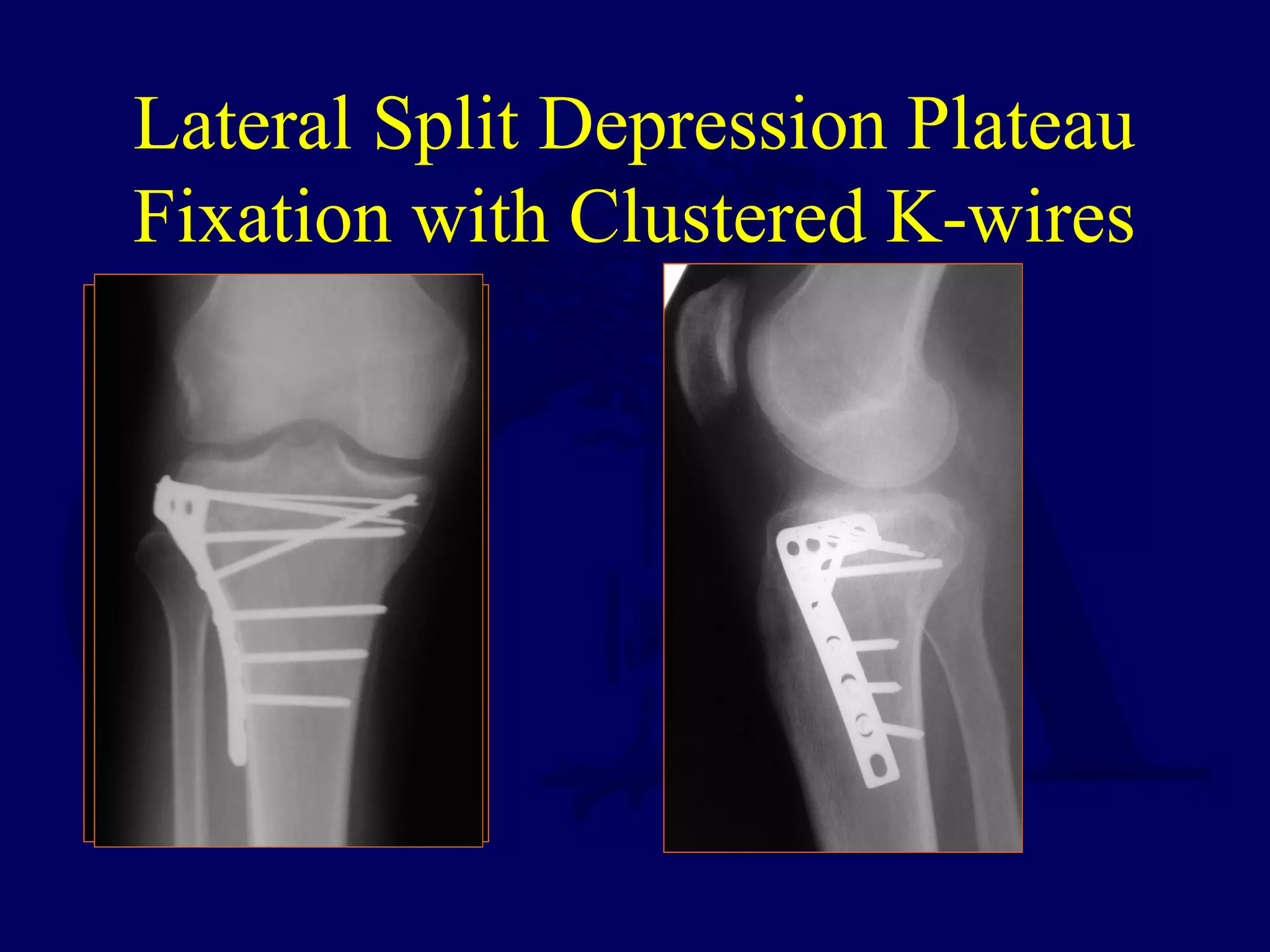 EBM - Tibial Plateau Fractures - Dr.Chintan N. Patel | PPT