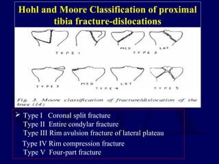 EBM - Tibial Plateau Fractures - Dr.Chintan N. Patel | PPT