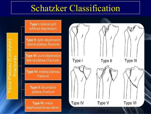 Schatzker Classification