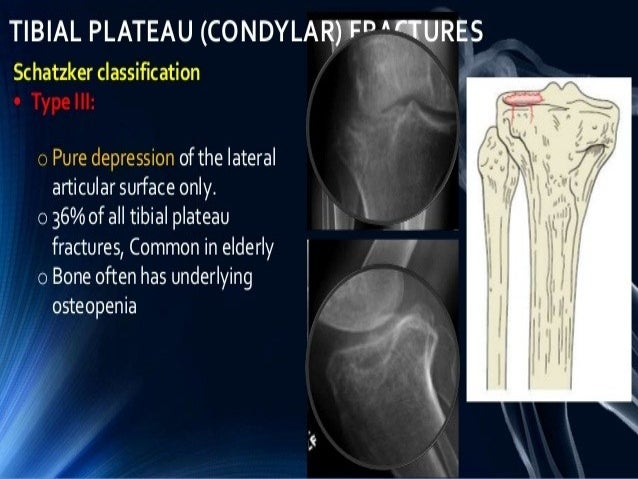 EBM - Tibial Plateau Fractures - Dr.Chintan N. Patel