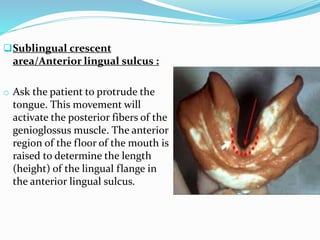 Sublingual Sulcus