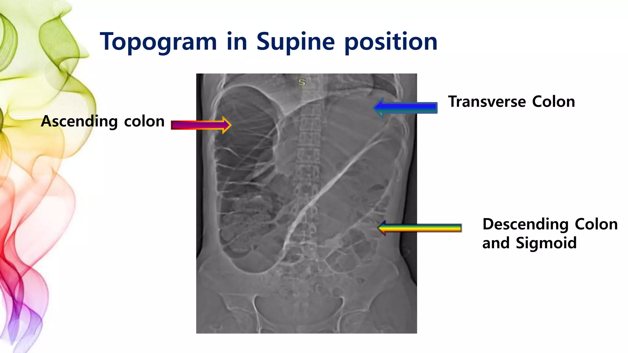 Transverse colon volvulus final | PPTX
