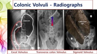 Transverse colon volvulus final | PPT