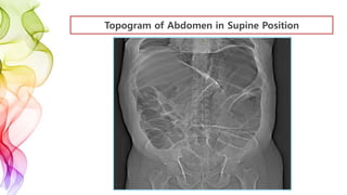 Transverse colon volvulus final | PPTX