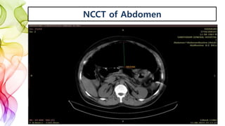 Transverse colon volvulus final | PPTX