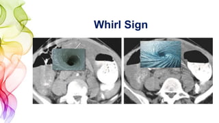 Transverse colon volvulus final | PPTX