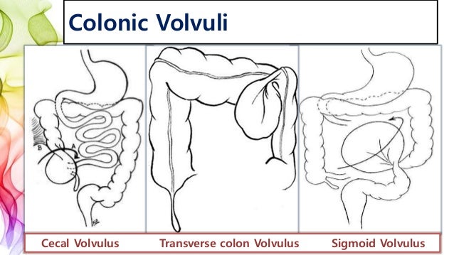 Transverse colon volvulus final
