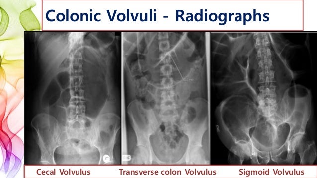 Transverse colon volvulus final